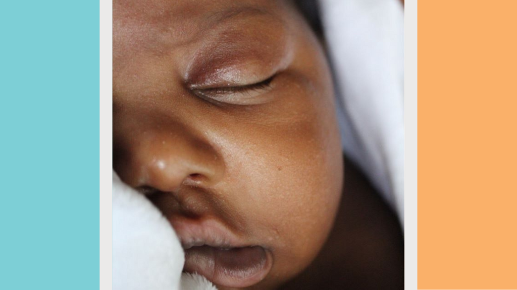 Heat Rash On Black Babies