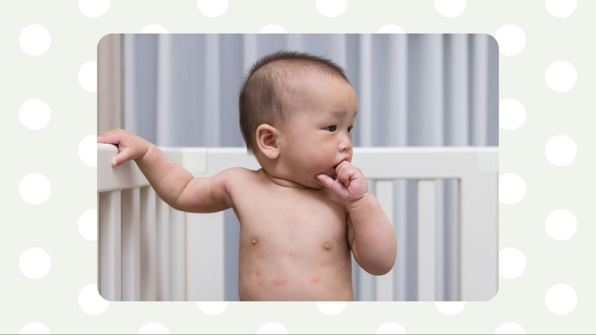 Impetigo in Babies: How to Identify, Treat & Prevent Spreading – NOLEO